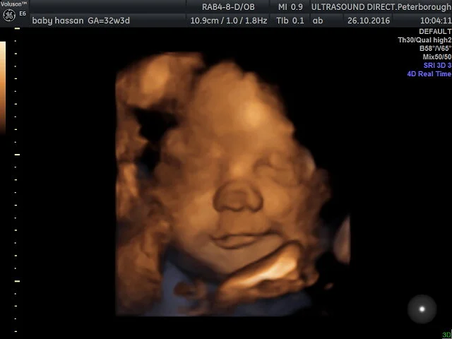 Pickle's 4D Bonding Scan | Ultrasound Direct, Peterborough | Me ...