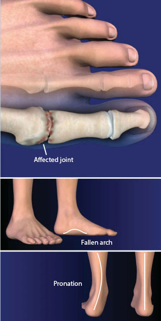 Hallux Rigidus (Stiff Big Toe) — Fix Your Feet