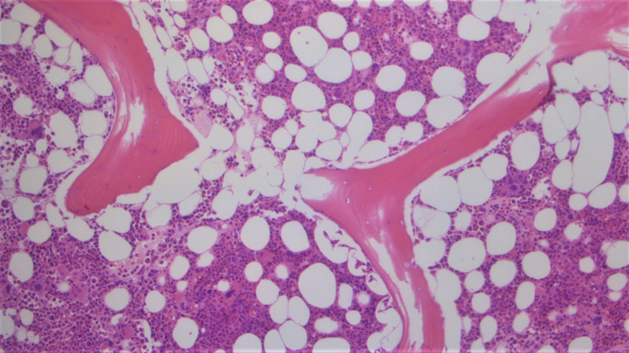 Bone Marrow Aspiration Vs Bone Marrow Trephine Biopsy Bone Marrow Aspiration Vs Bone Marrow Trephine Biopsy