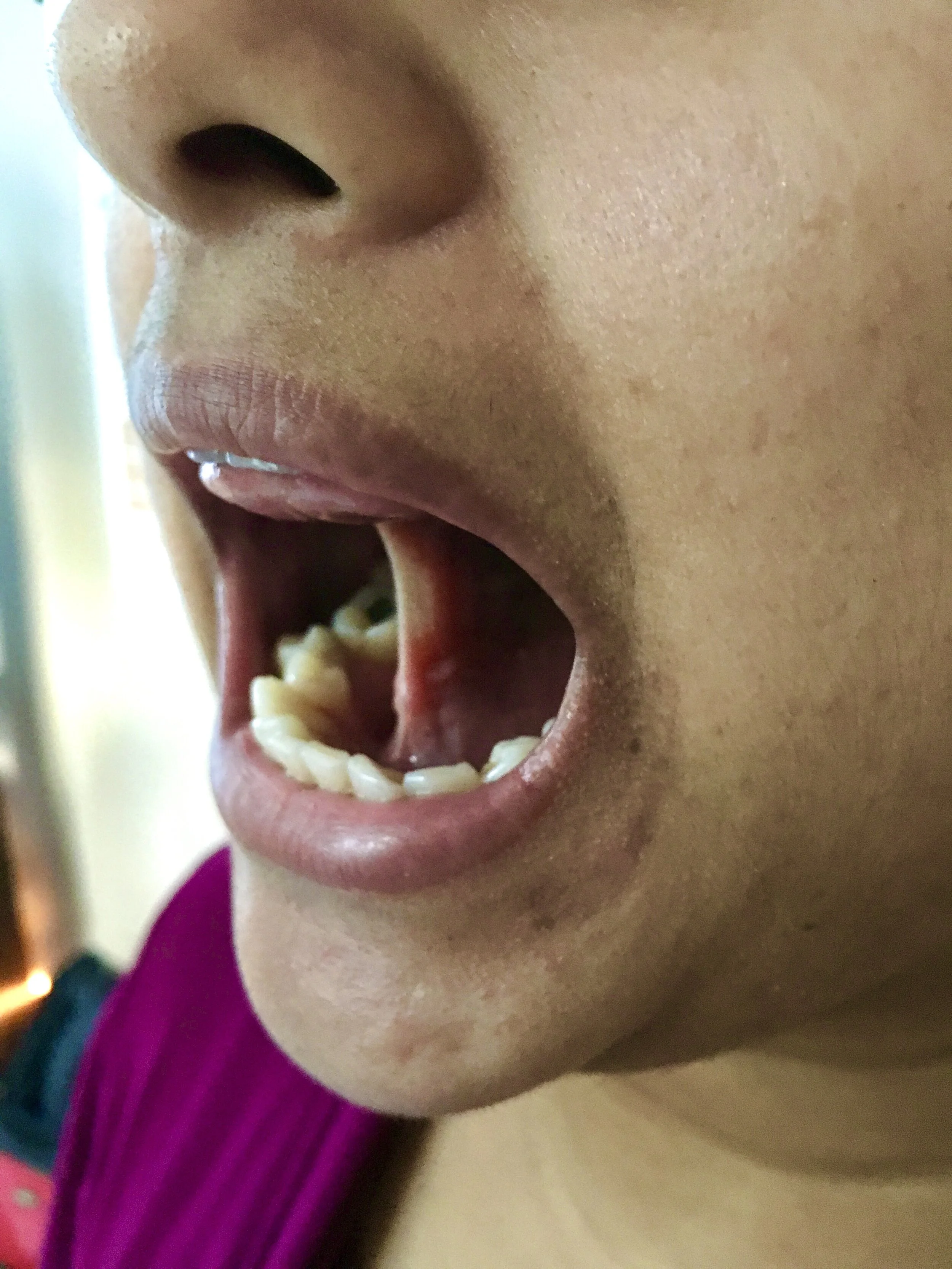 Tongue Ties — CFT - The Gillespie Approach