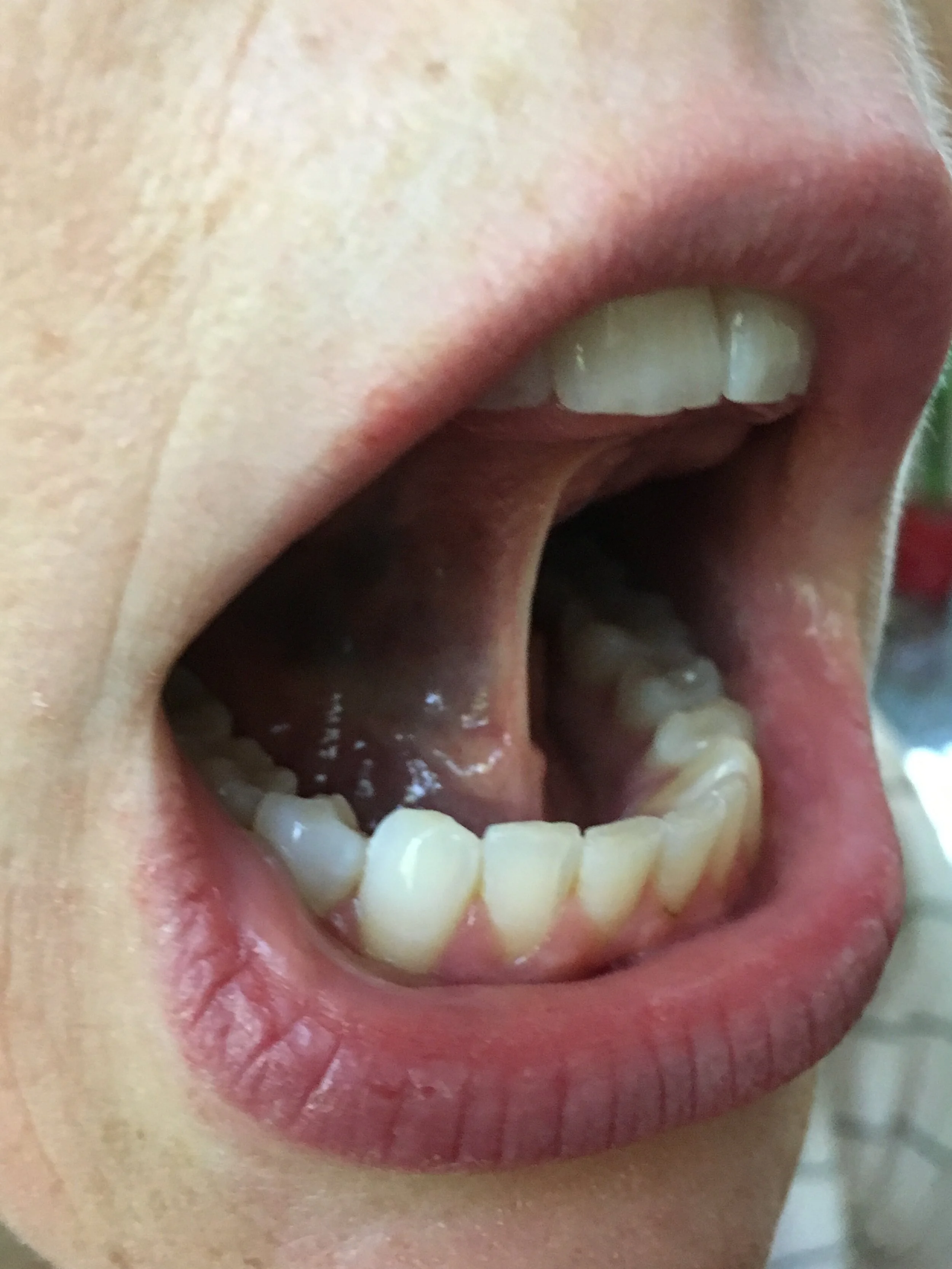 Tongue Ties — CFT - The Gillespie Approach