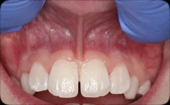 Tongue Ties — CFT - The Gillespie Approach