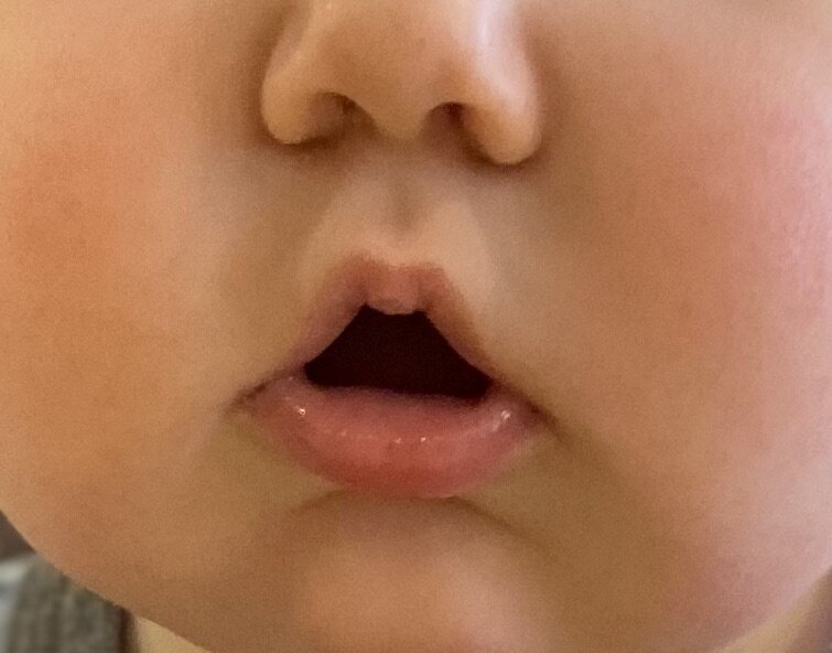Tongue Ties — Cft The Gillespie Approach