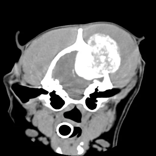 Bone Tumors - Skull — DR. JULIUS LIPTAK