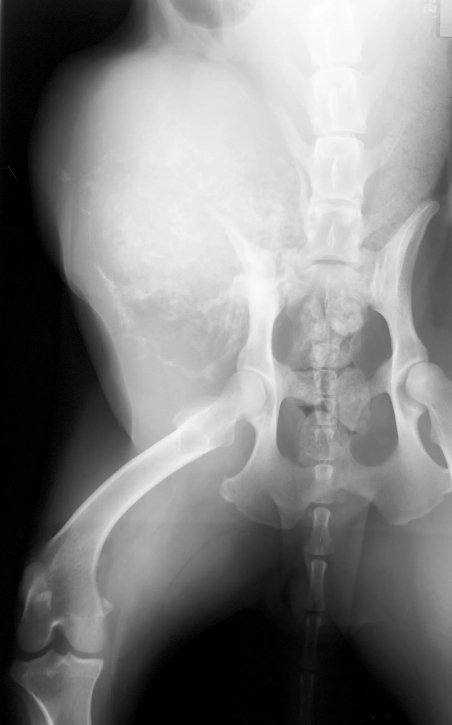 Bone Tumors Pelvic DR JULIUS LIPTAK