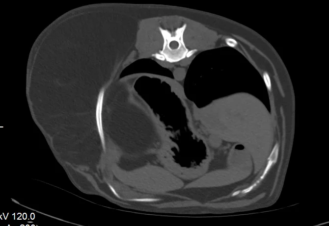 Skin Tumors - Lipoma — DR. JULIUS LIPTAK
