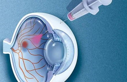 La DMLA — Centre Ophtalmologique Essonne