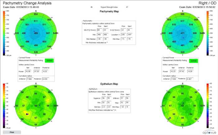 Chirurgie réfractive : qu'est ce que la pachymétrie? — Centre ...