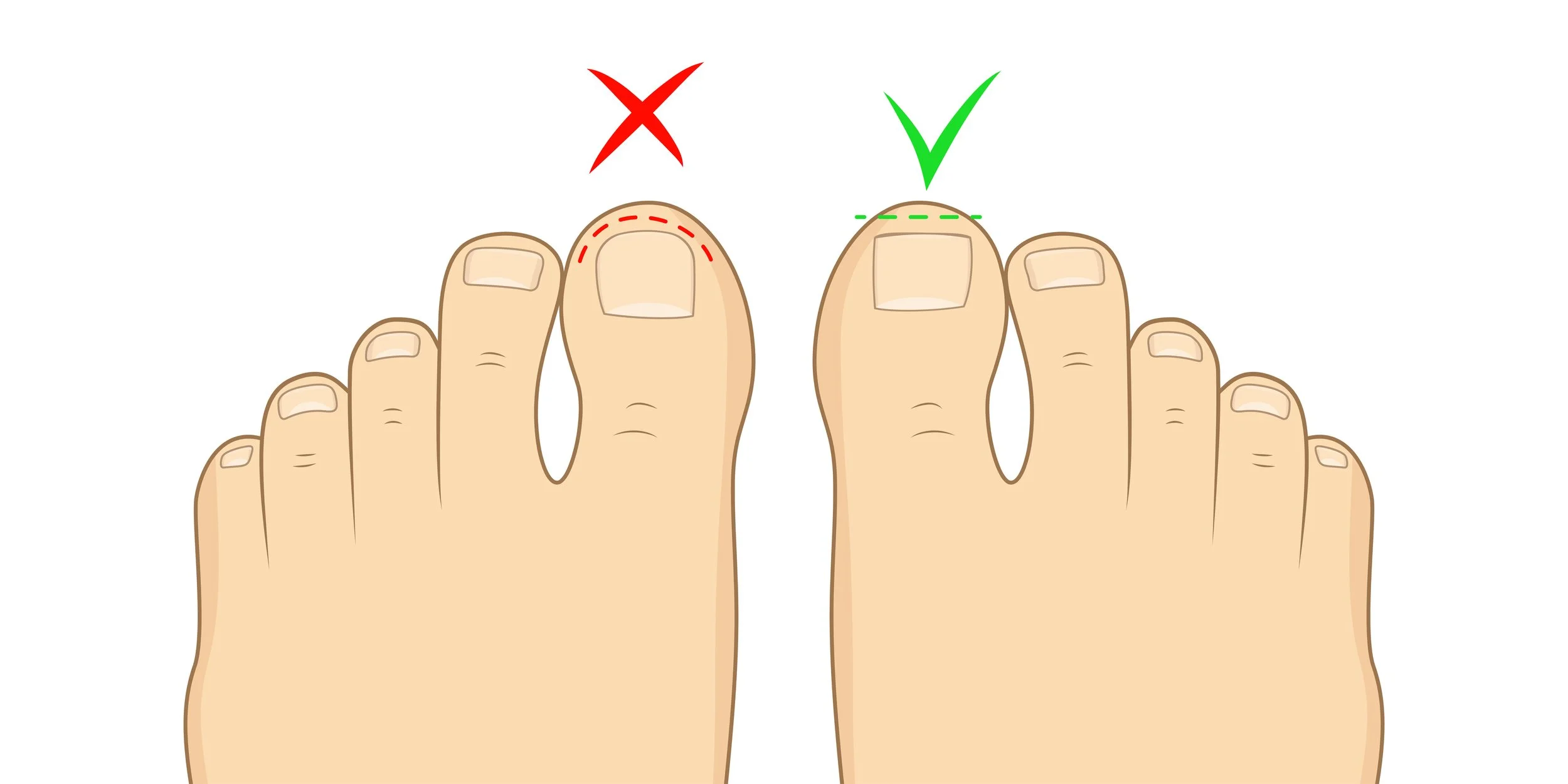 How to Cut Your Toenails Correctly — Blackwood Podiatry | Your local ...