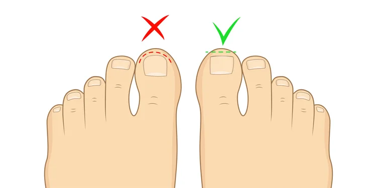 How to Cut Your Toenails Correctly — Blackwood Podiatry | Your local ...