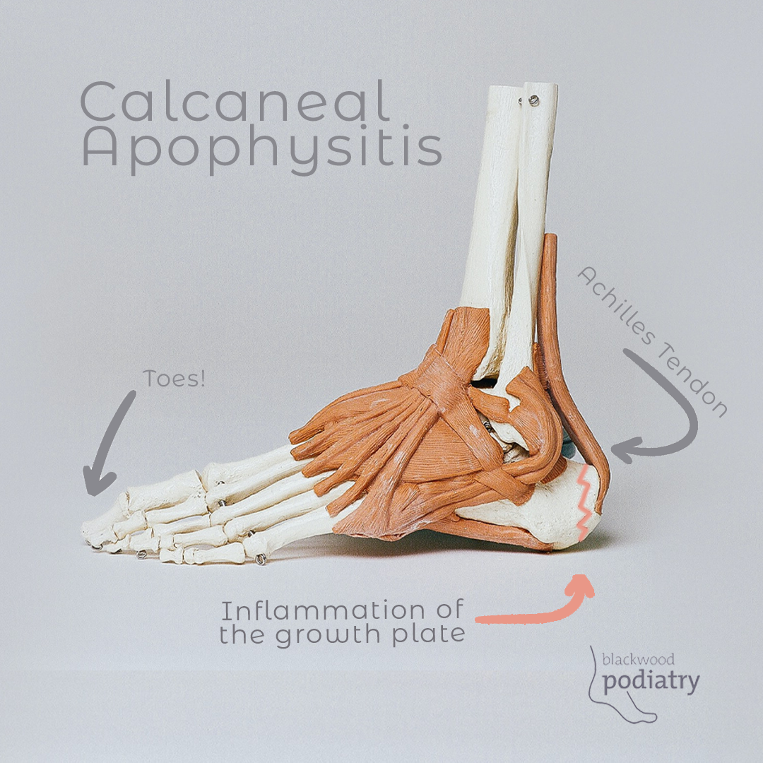 A common cause of heel pain in children — Blackwood Podiatry ...