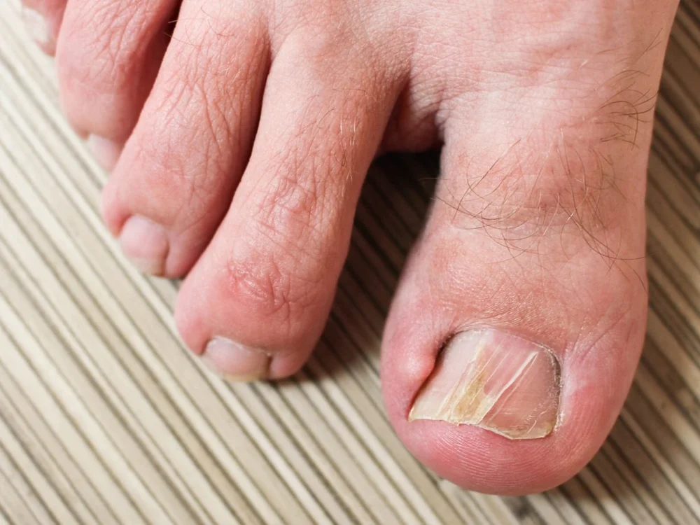Toenail Troubles — Blackwood Podiatry | Your local podiatrist in Blackwood