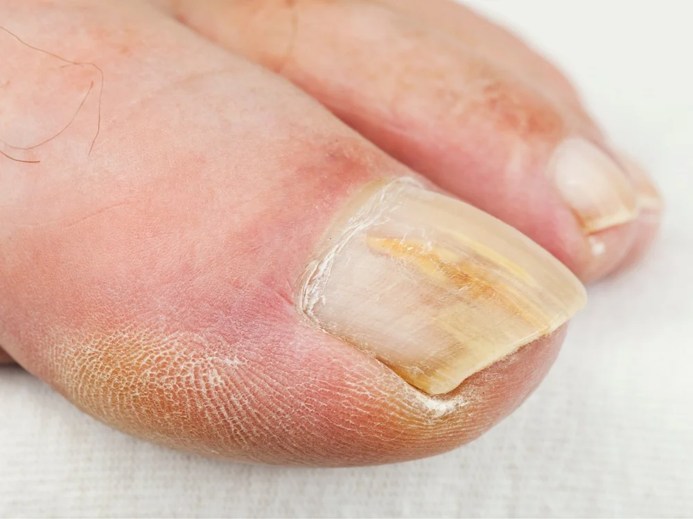 Toenail Troubles — Blackwood Podiatry | Your local podiatrist in Blackwood