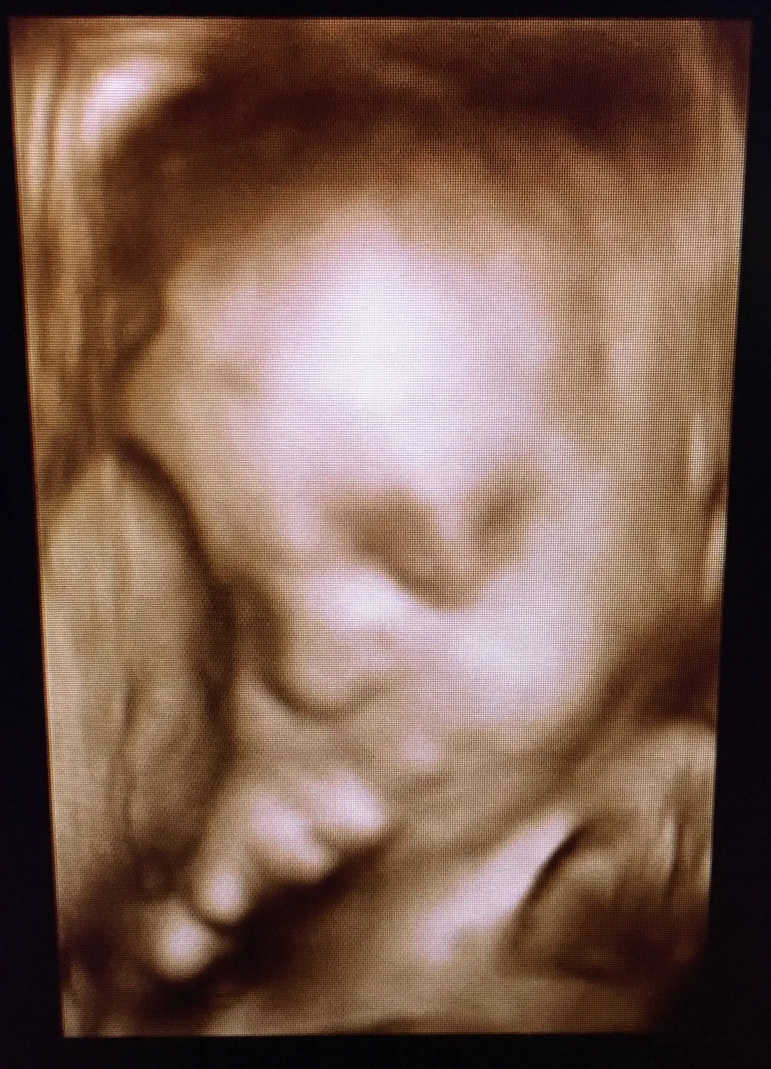 Dwarfism Awareness Month: A Recap — The Joy of Mira