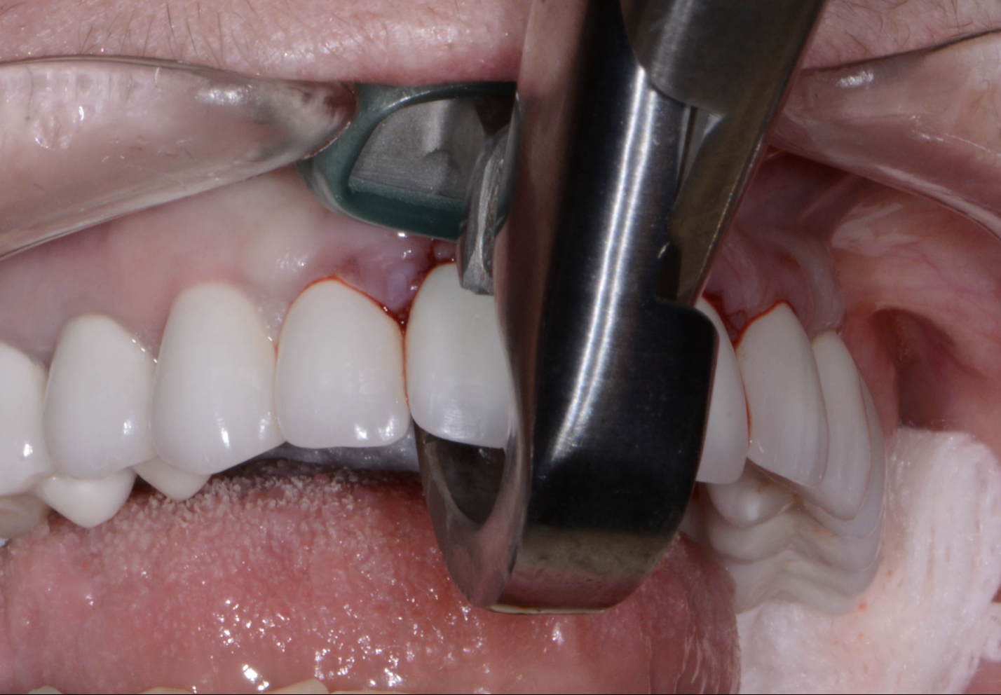 AMP2 Plus: Info — Amplify Dental