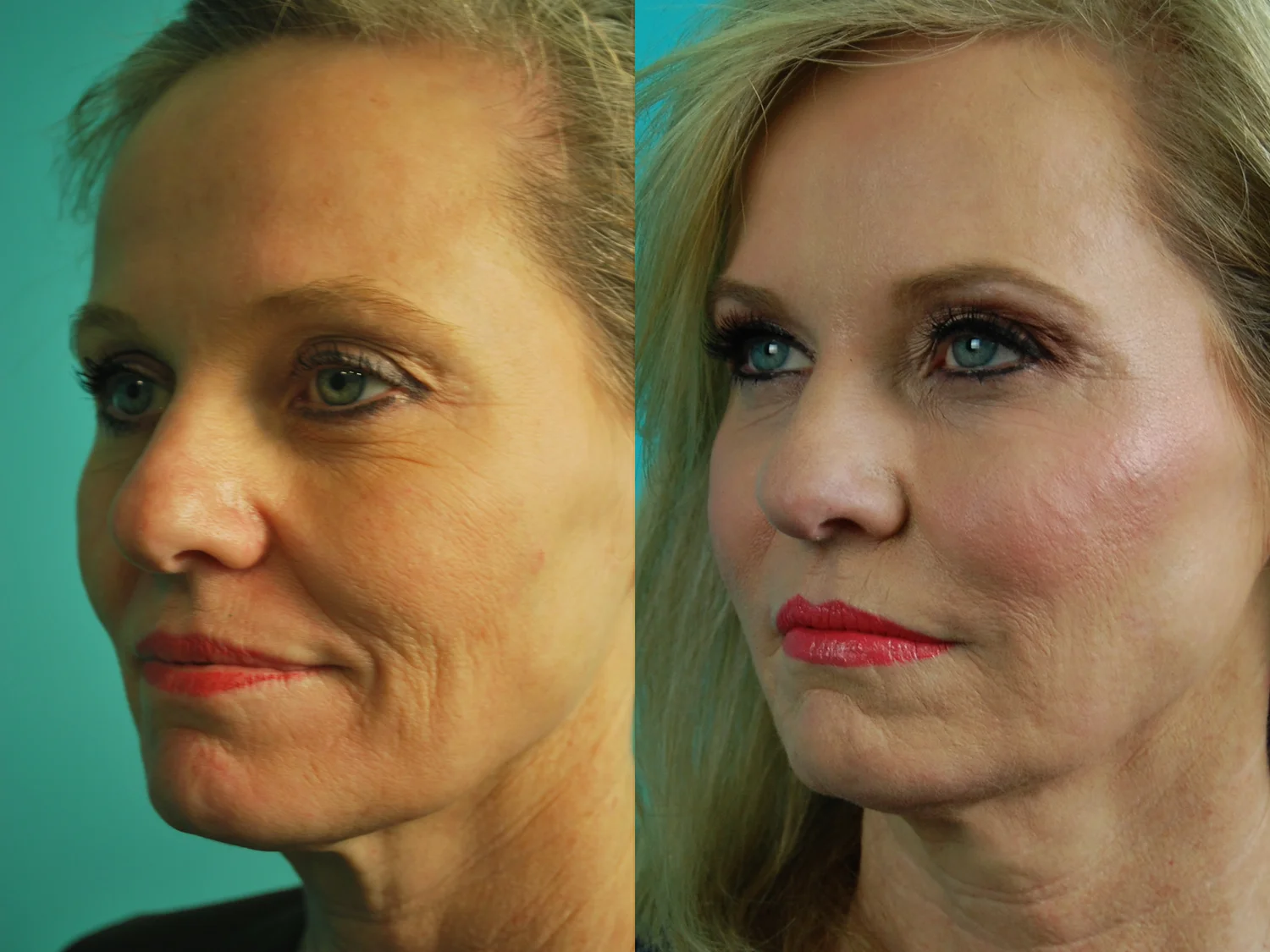 Injectables | Facelifts, Injectables & Lasers | Petro Facial Plastic ...