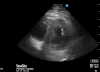 The D-sign: Right Ventricular Strain — TPA