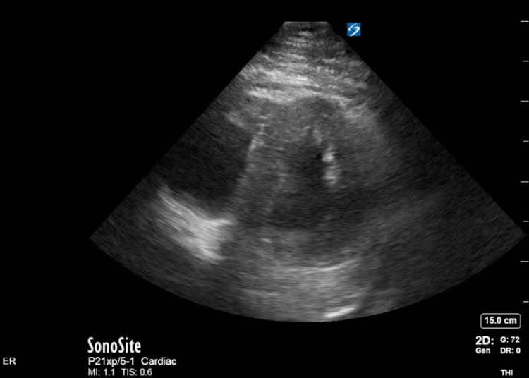 The D-sign: Right Ventricular Strain — TPA