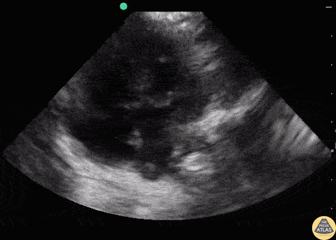Other Cardiac Pathology — TPA