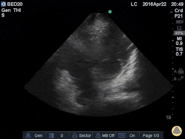 Other Cardiac Pathology — TPA