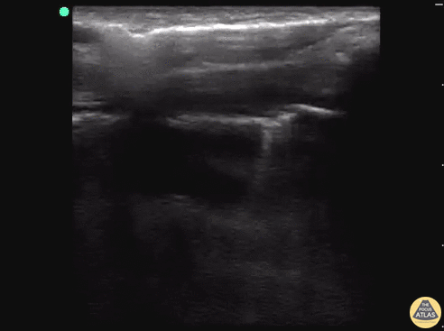 POCUS: pneumothorax | fan of EM
