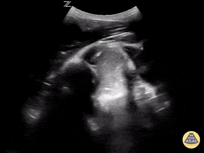 Musculoskeletal — TPA