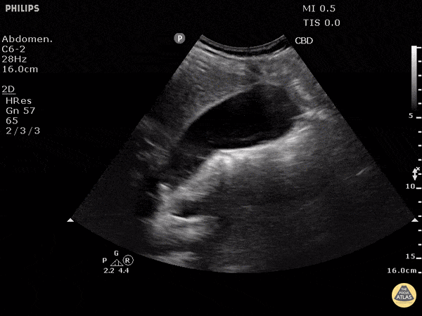 Biliary Evidence — TPA