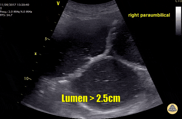 Bowel-GI — TPA