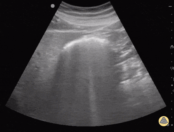 Bowel-GI — TPA