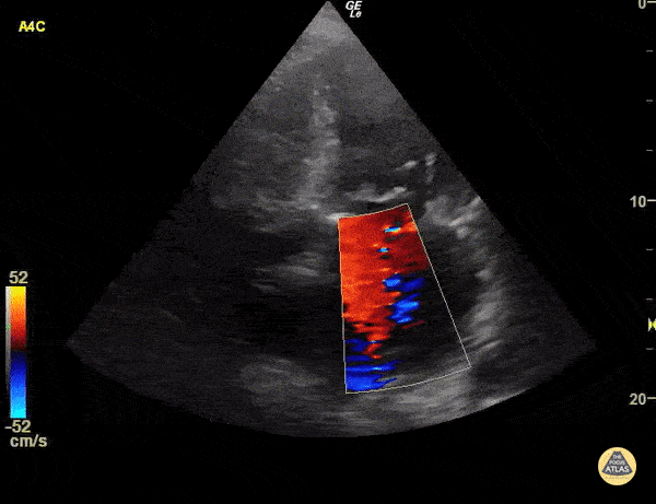 Echocardiography — TPA