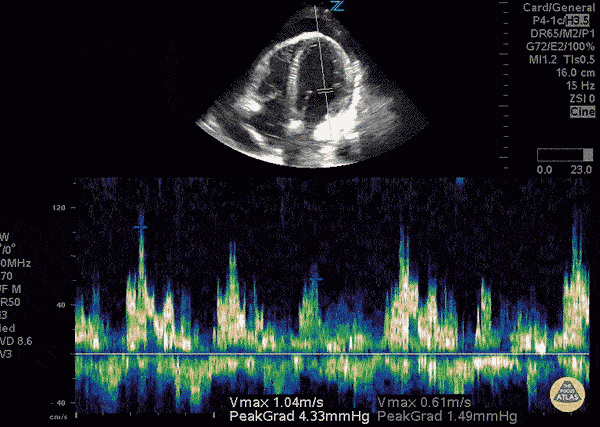 Pericardial Disease — TPA