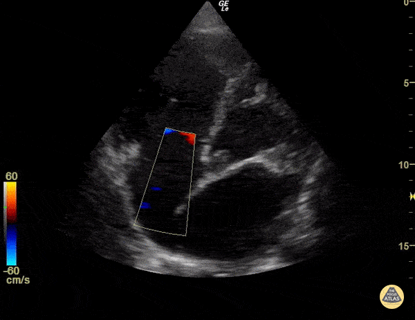 Right Ventricular Dysfunction — TPA