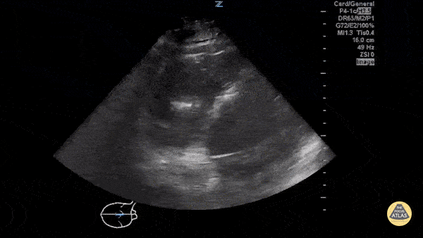Echocardiography — TPA
