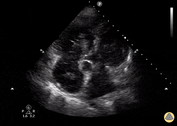 Pulmonary Embolism Archives Ucsd Ultrasound