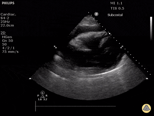 Pericardial Disease — TPA