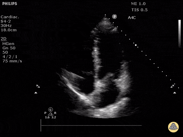 Normal Cardiac Anatomy — TPA