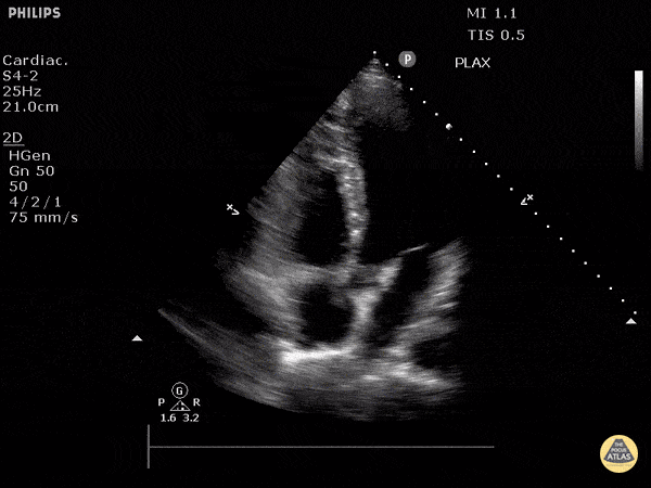 Normal Cardiac Anatomy — TPA