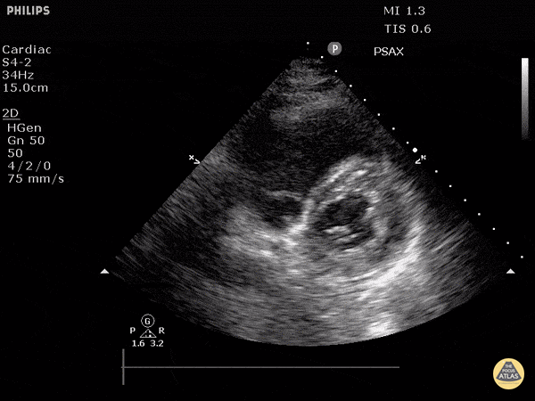 Right Ventricular Dysfunction — TPA
