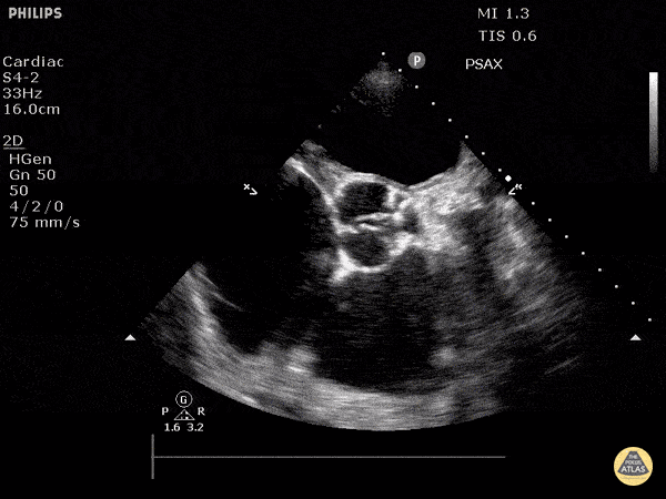 Echocardiography — TPA