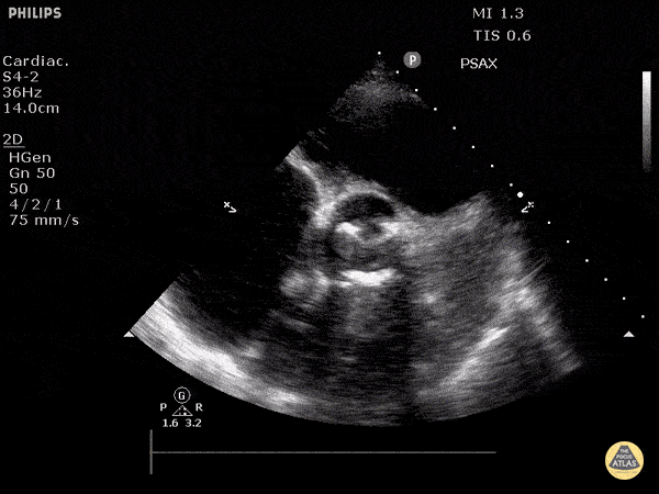 Valvulopathy — TPA