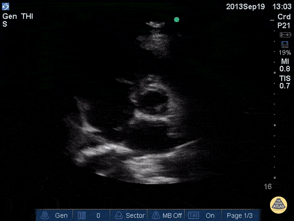 Echocardiography — TPA
