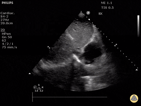 Normal Cardiac Anatomy — TPA