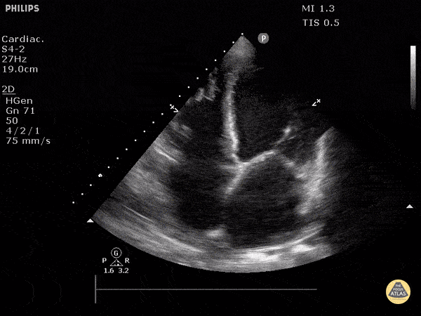 Echocardiography — TPA