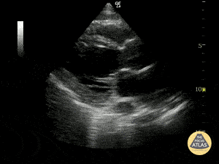 Left Ventricular Dysfunction — TPA