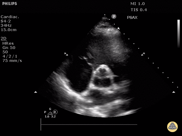 Normal Cardiac Anatomy — TPA