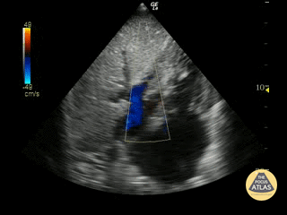 Echocardiography — TPA