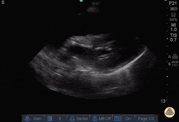 Left Ventricular Dysfunction — TPA