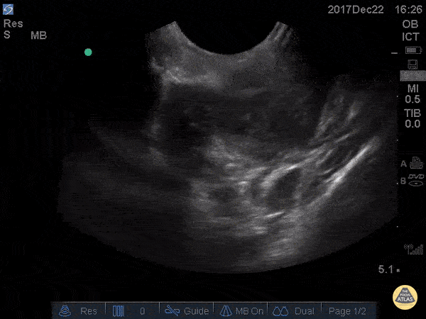 Peritonsillar Abscess Ultrasound