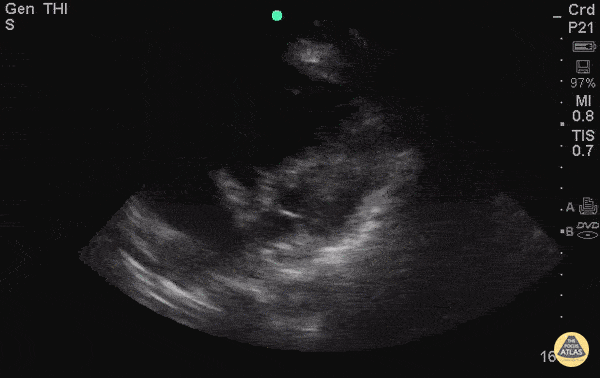 Right Ventricular Dysfunction — TPA