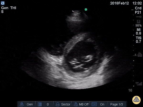 Left Ventricular Dysfunction — TPA